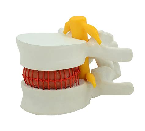 Buy Human Anatomical Lumbar Disc Herniation Model Lumbar Spine Model