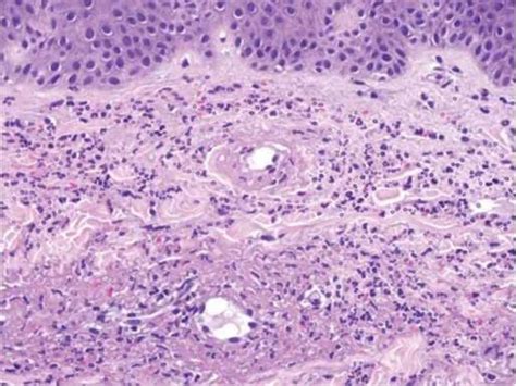 Histopathologic Features Of Leukocytoclastic Vasculitis A Form Of