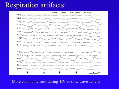 artifacts in eeg final