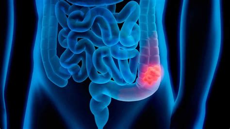 Cáncer de Colon 5 síntomas clave