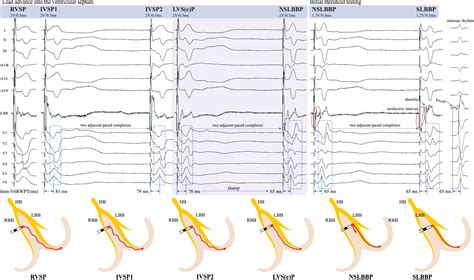 A Continuous Pacing And Recording Technique For Differentiating Left