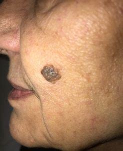 Seborrheic Keratosis Removal In SG Stratum Skin And Surgery