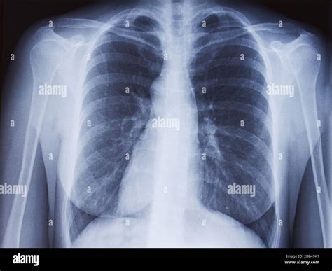 Cómo Interpretar Una Radiografía De Tórax 44 OFF