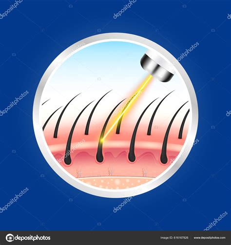 Laser Hair Removal Unwanted Out Make Skin Smooth Medical Beauty Stock