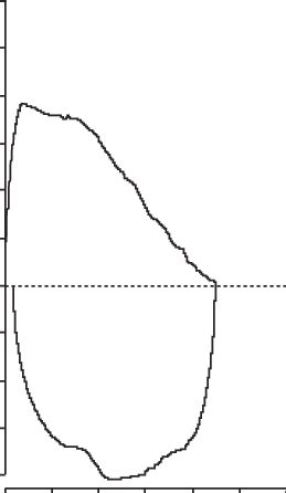Muscular Dystrophy Flow Volume Loop