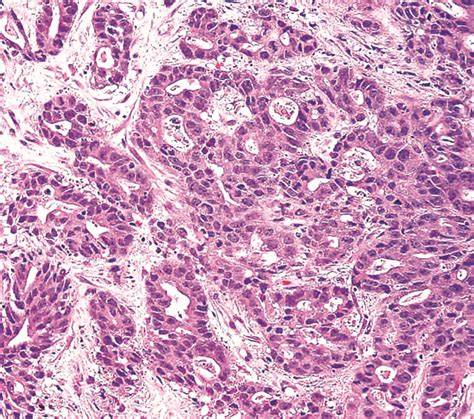 Pathology Outlines Adenocarcinoma