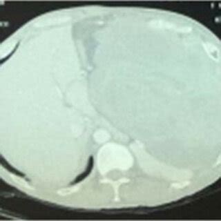 Axial Section Of Abdominal Computed Tomography With Contrast Performed