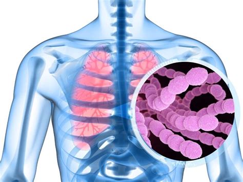 Pneumokoki objawy jak dochodzi do zakażenia i sposoby by go uniknąć