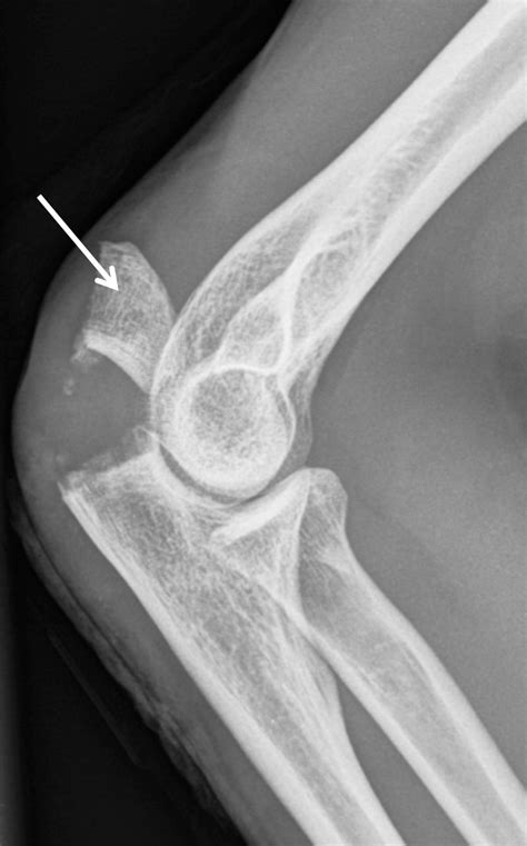 Fracture du coude Clinique Ostéo Articulaire des Cèdres Grenoble