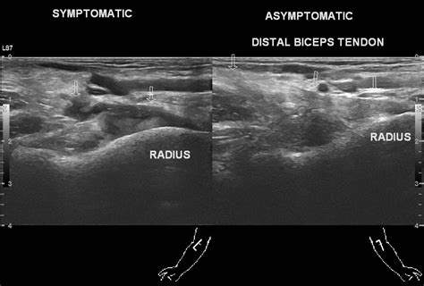 Distal Biceps Tendon Rupture Image Radiopaedia Org