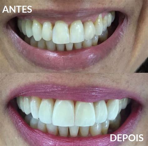 Lente de contato dental O que é Implantes Dentários Implantelaser