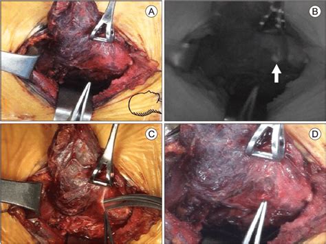 Case 2 A The Left Inferior Parathyroid Could Not Be Found On Naked