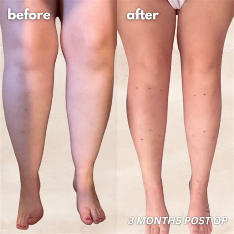 Una Gu A Completa Sobre Las Etapas Y Tipos De Lipedema