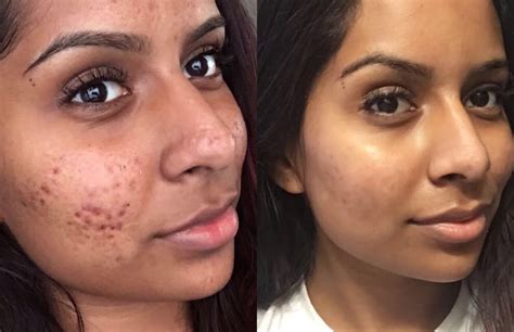 Makeup That Causes Cystic Acne Saubhaya Makeup