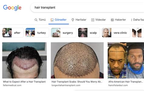 Jamie Foxx Hair Transplant Surgery Before After Results