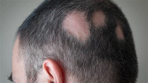 Enfermedades detrás de la pérdida de cabello
