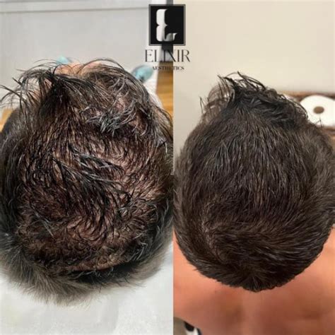 Exosome Therapy At Elixir Aesthetics Hair Restoration Facial Fillers