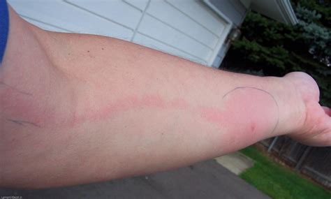Mosquito Bites Why Do Red Lins Appear R AskBiology