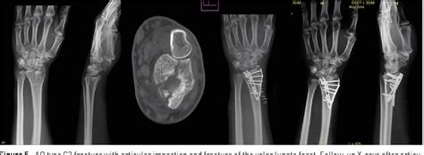 Figure From Fragment Specific Fixation For Complex Intra Articular