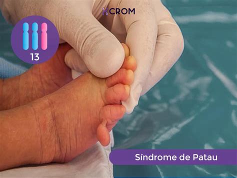 Ficha técnica Síndrome de Patau CROM Instituto de Citogenética Humana