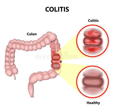Ulcerative Colitis Stock Vector Illustration Of Inflammation 124368155