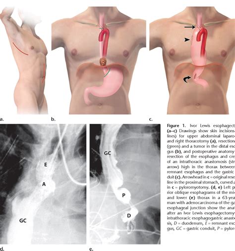 Figure 3 From Esophagectomy And Gastric Pull Through Procedures