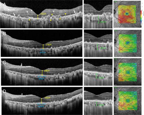 Spectral Domain Optical Coherence Tomography And Enhanced Depth