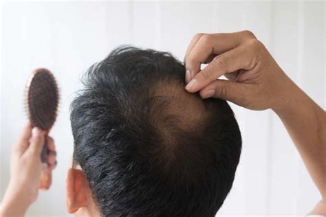 Alopecia Difusa Causas y Síntomas MyCapil