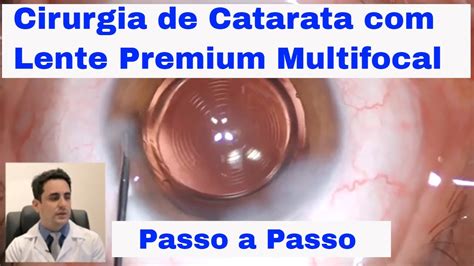 Cirurgia De Catarata Lente Premium Multifocal Passo A Passo YouTube