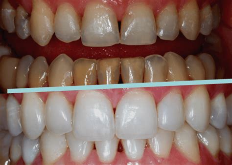 Restaurações em resina Adriana Lànger Odontologia Estética