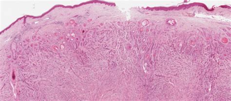 Peyton Riley Oral Pathology Chapter Flashcards Quizlet