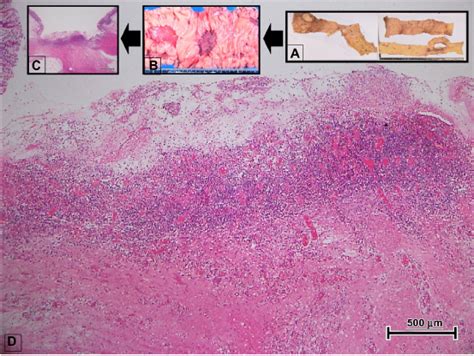 Findings Of The Resected Colon Macroscopic Findings Of The Whole Area