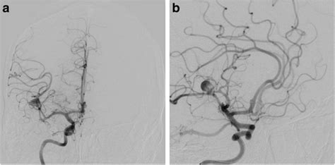 Digital Subtraction Angiography DSA Selective Right Internal Carotid