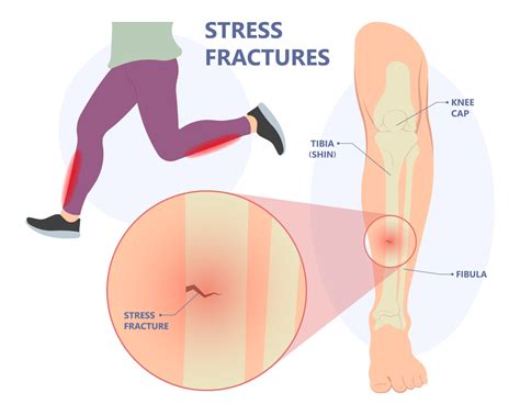 Stress Fracture Types Symptoms Causes Treatment Zealmax