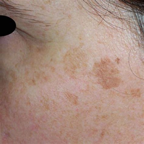 manchas piel cara 02 Centro de Estética Elena Somoano Oviedo