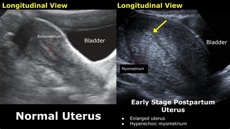 SOLUTION Postpartum Uterus Ultrasound Normal Vs Abnormal Studypool