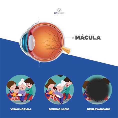 Degeneração Macular Relacionada à Idade MS Visão