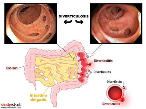 Diverticulosis y diverticulitis síntomas y tratamiento