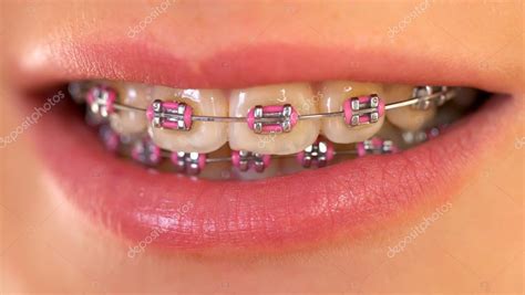 Pink Braces Stock Photo Ocskaymark 46945801
