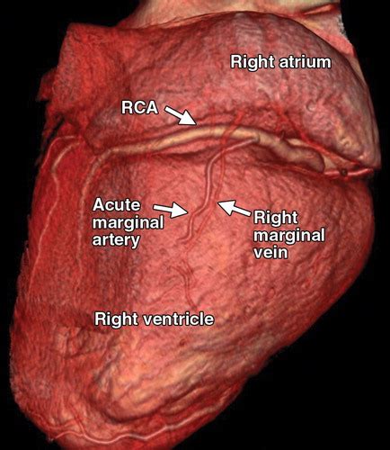 Imaging Of The Coronary Sinus Normal Anatomy And Congenital