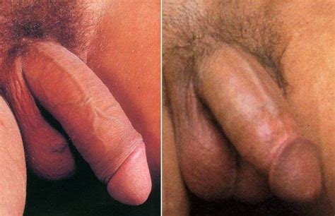 Erect Circumcised Vs Uncircumcised