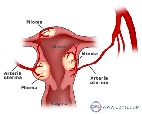 Tienes Un Mioma CDyTE