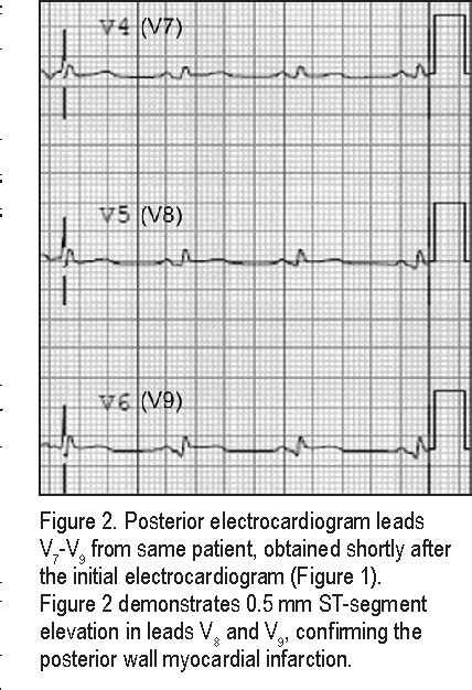 Figure 2 From ECG Diagnosis Isolated Posterior Wall Myocardial