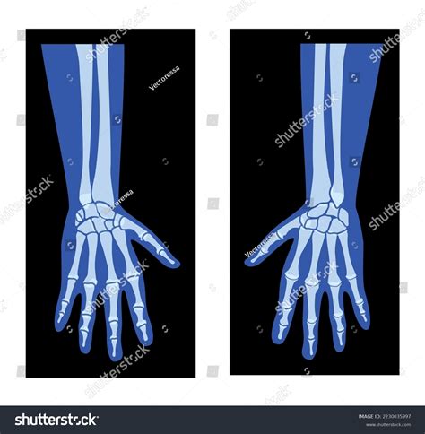 Xray Hands Radius Ulna Skeleton Human Stock Vector Royalty Free 2230035997 Shutterstock