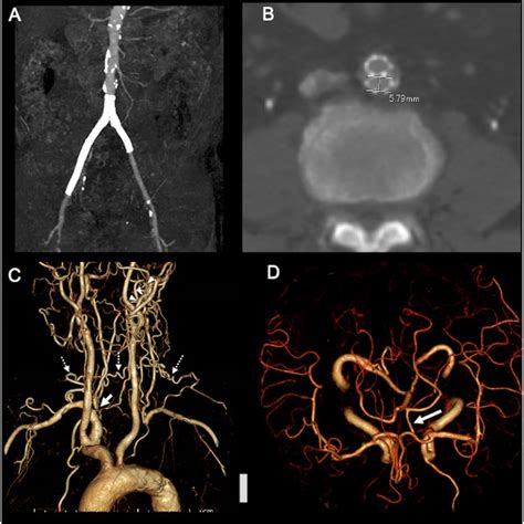 A Computed Tomography Angiography CTA Demonstrates Two Stents In