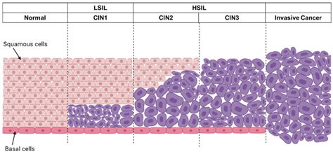 An Overview Of The Progression Of Cervical Cancer Squamous Cells Are