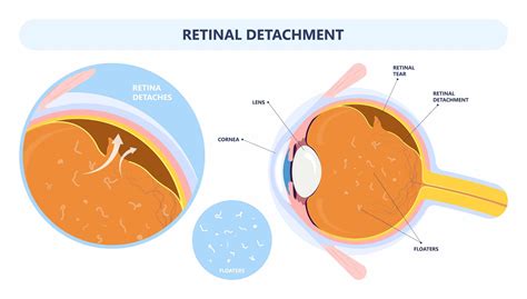 Retinal Detachment Alaska Retinal Consultants