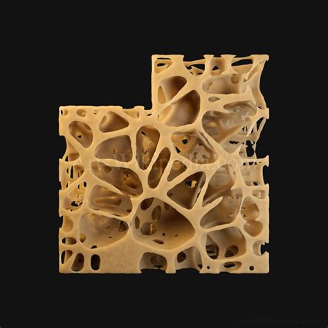 D Osteopenia Histology Of Spongy Bone Structure