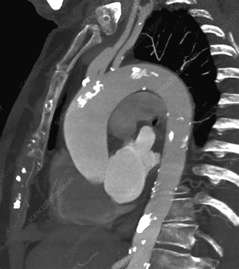 Aortic Aneurysm CT Scan Stock Image C052 9276 Science Photo Library