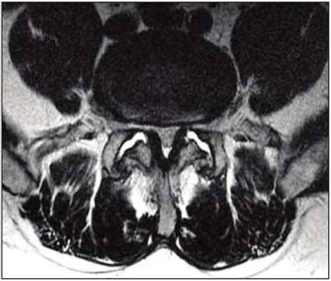 Impact Of Patient Reported Symptom Information On Lumbar Spine MRI